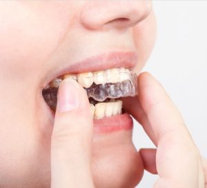 Mandibular Advancement Splint | Melbourne Dental Sleep Clinic